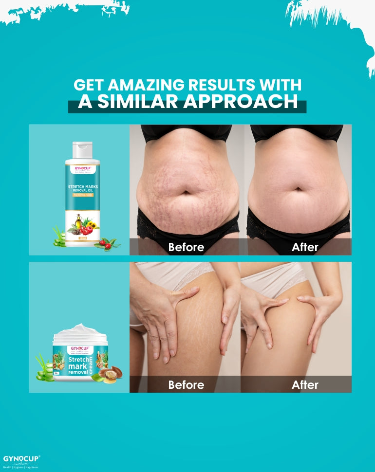 Natural Anti-Stretch Marks Kit– GynoCup